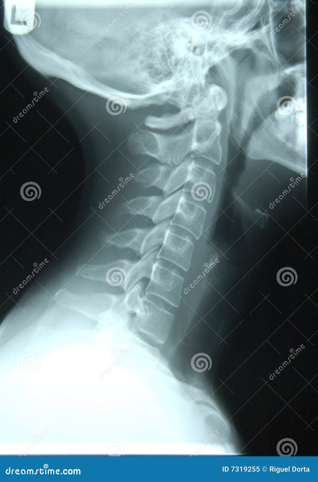 X-ray of human neck stock image. Image of human, vertebrae - 7319255