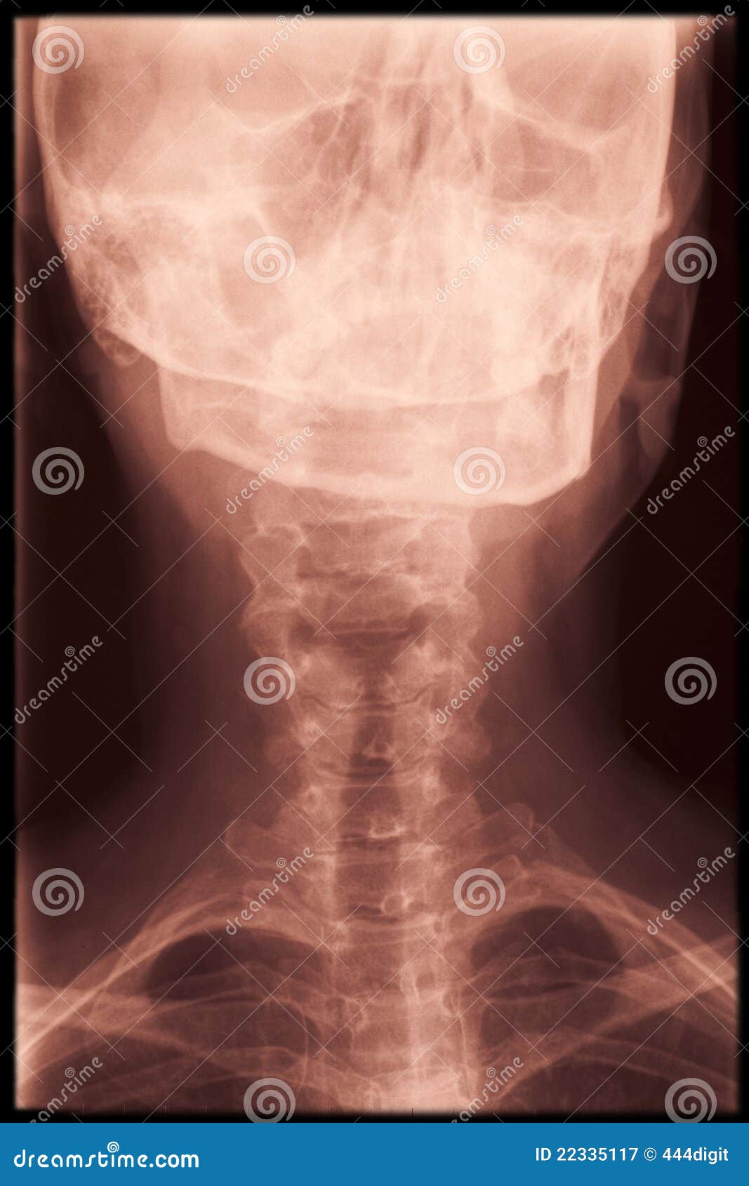 X-ray of a Human Neck and Skull Stock Image - Image of medical, balack ...