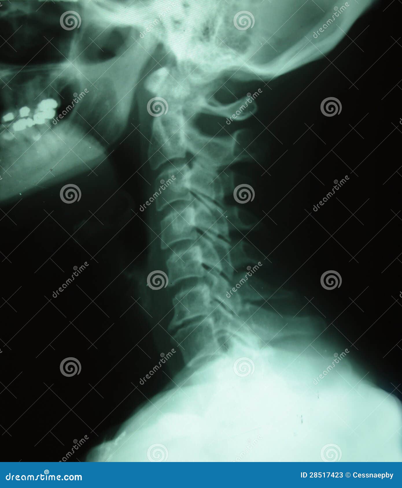 X-ray Human Piece of Skull and Spine Stock Image - Image of joint ...