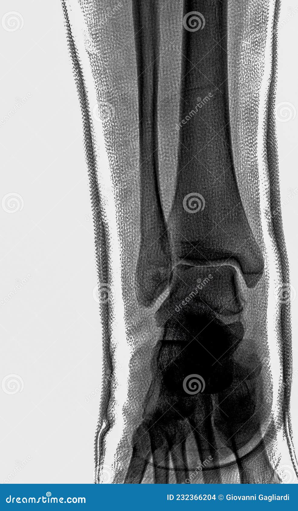 X-ray of Human Right Foot. View from Top Stock Photo - Image of illness ...