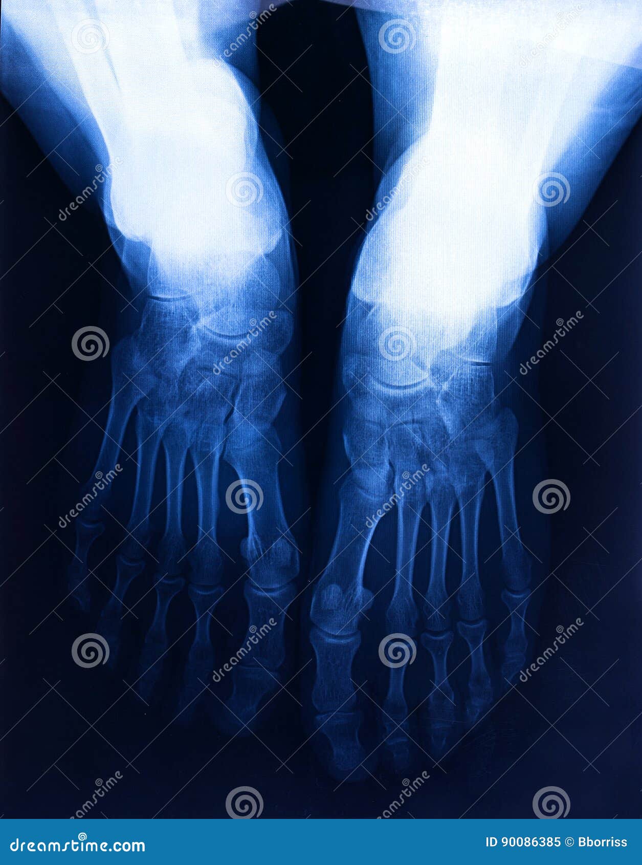 X-ray Human`s Ankle with Arthritis , Top View. Stock Image - Image of ...