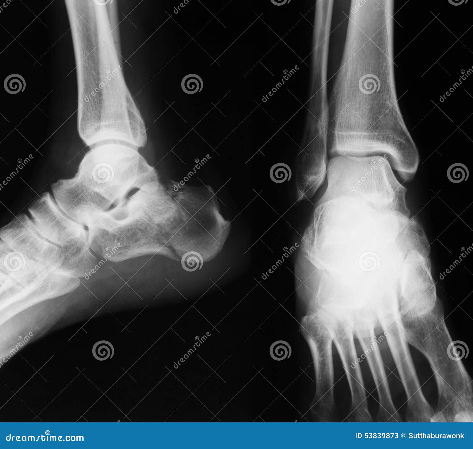 X Ray Ankle Ap