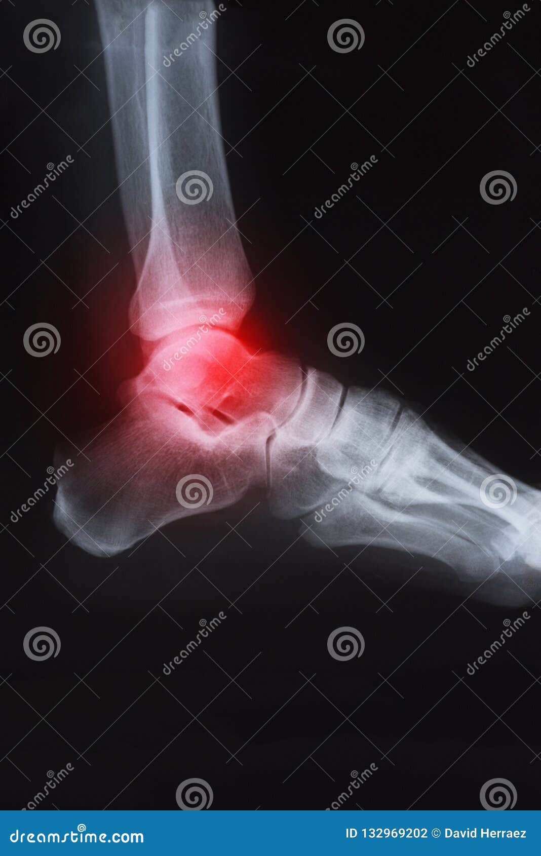 X Ray Image of Ankle with Arthritis Stock Photo - Image of body ...