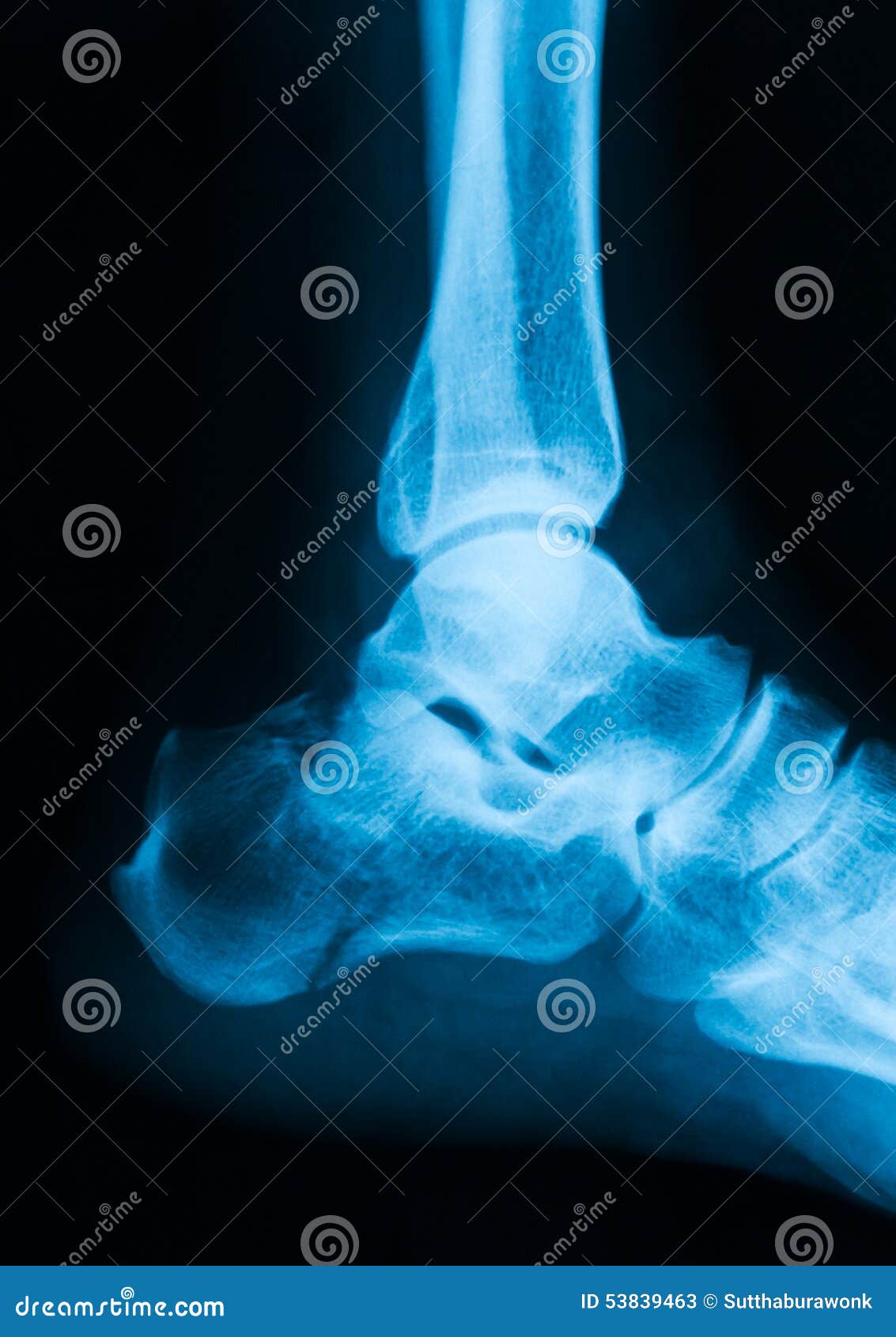 X-ray Image of Ankle, Lateral View. Stock Image - Image of scan ...
