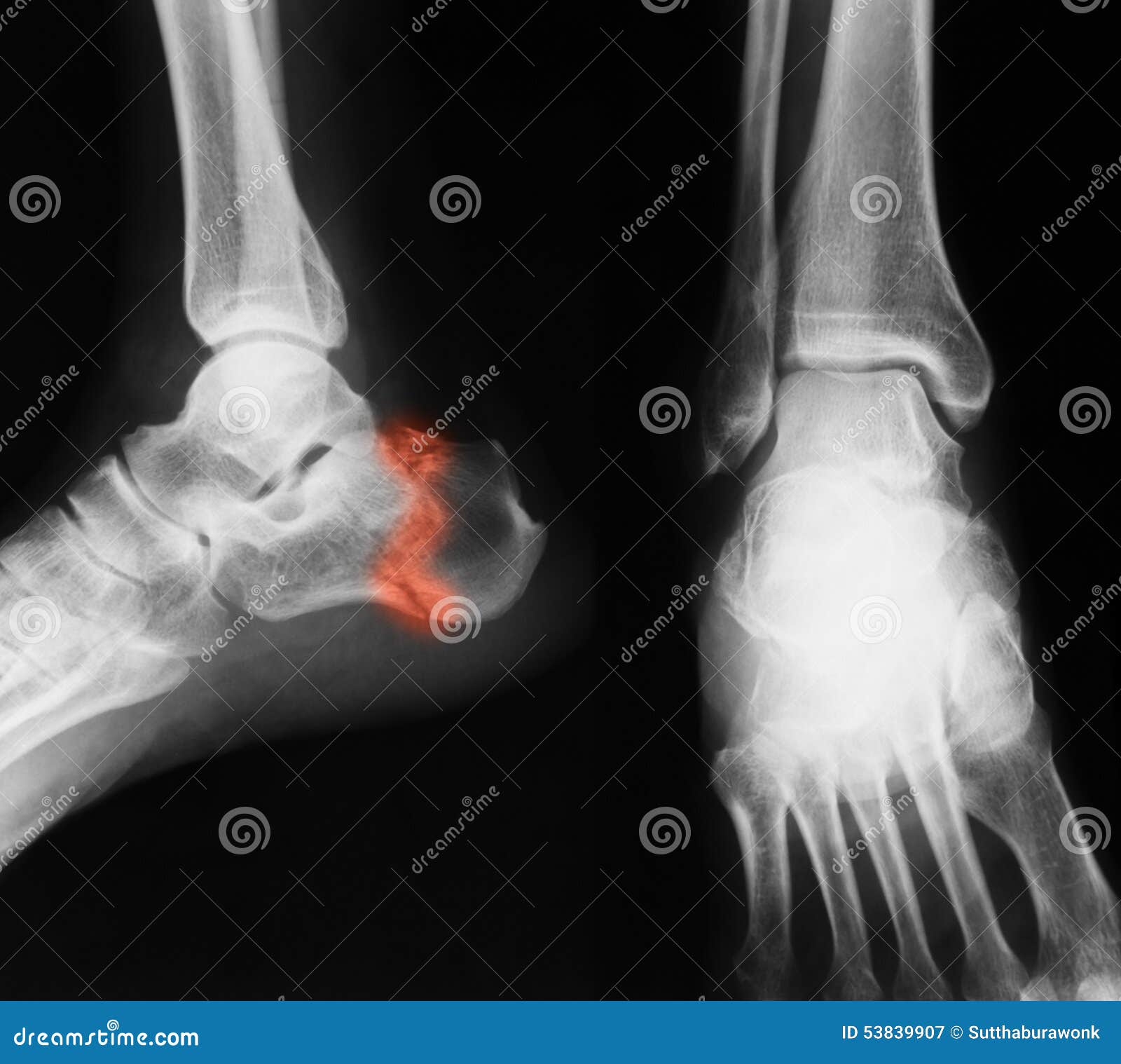 X-ray Image of Ankle, Lateral View. Stock Image - Image of scan ...