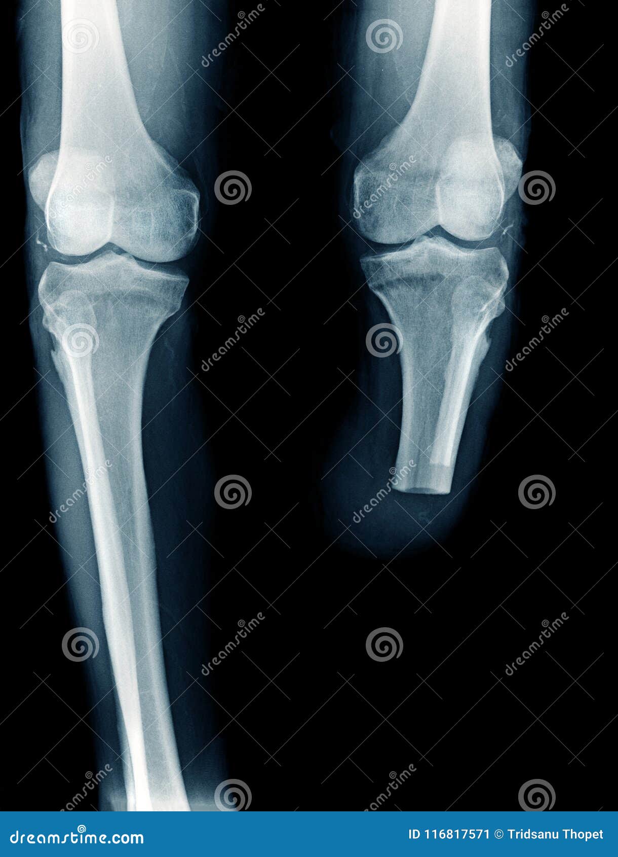 BKA x-ray image stock image. Image of knee, angiogram - 116817571