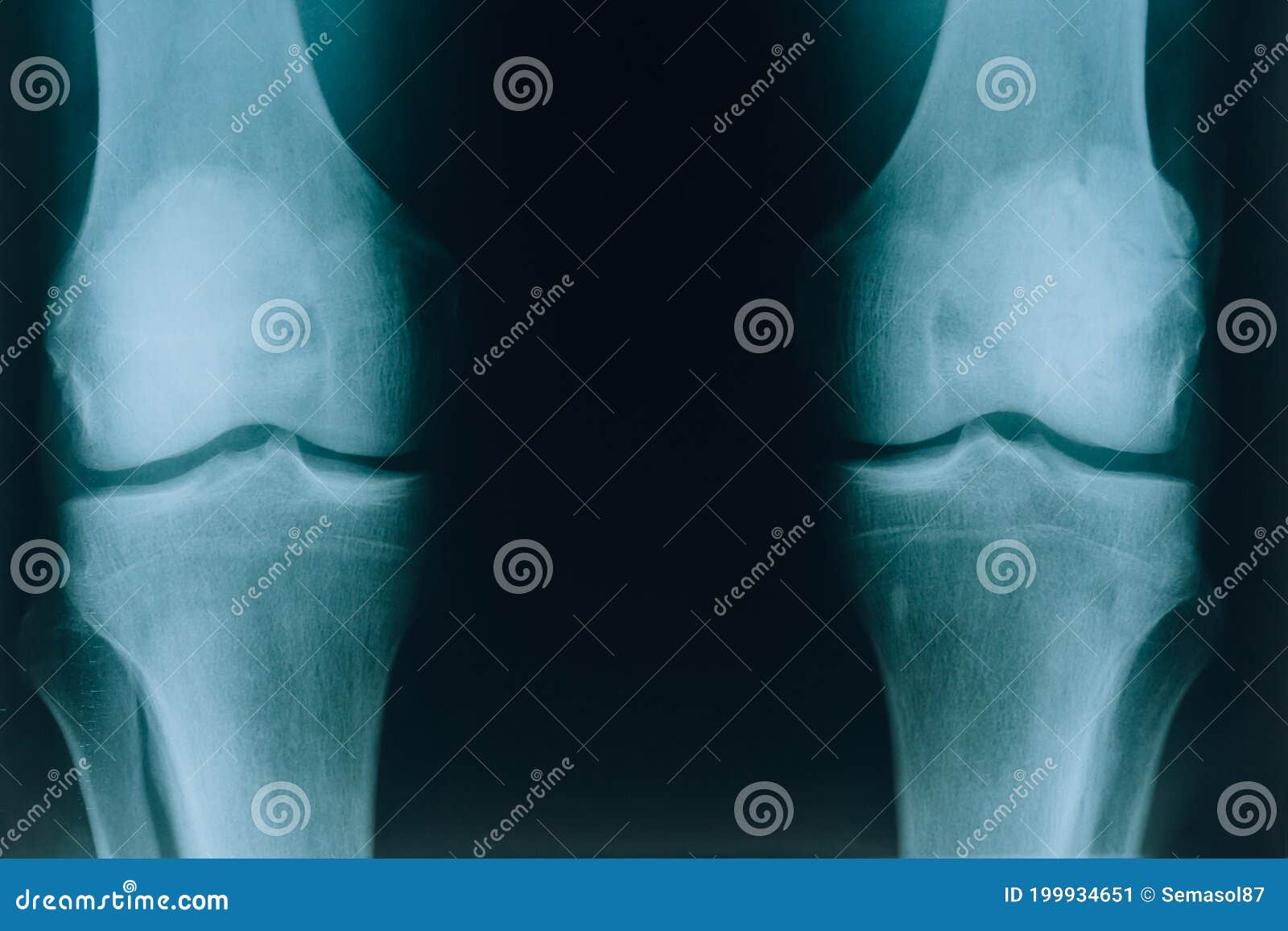 X-ray. an Image of the Bones and Joints of the Legs Stock Image - Image ...