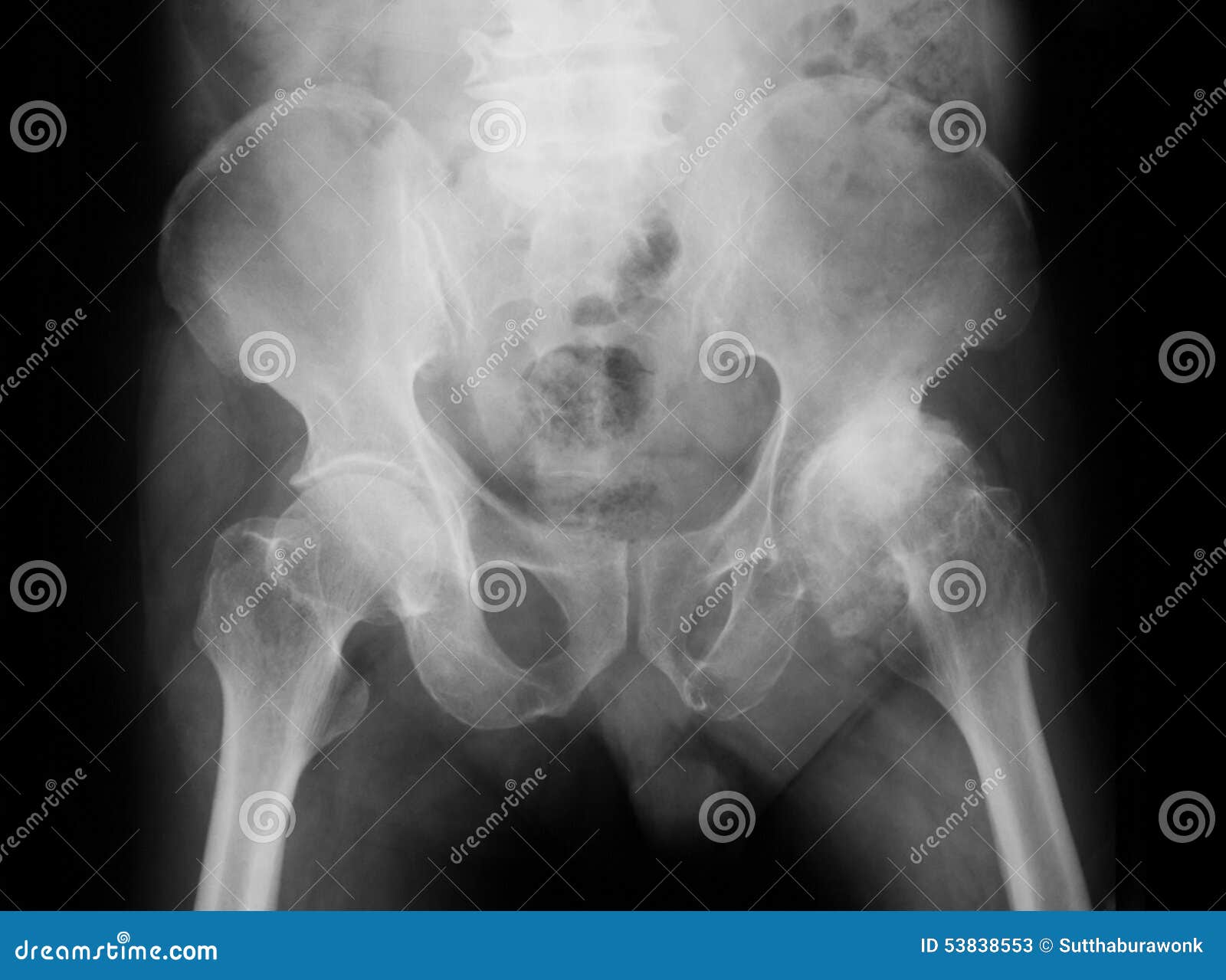 X-ray Image of Both Hip, AP View. Stock Image - Image of exam, care ...