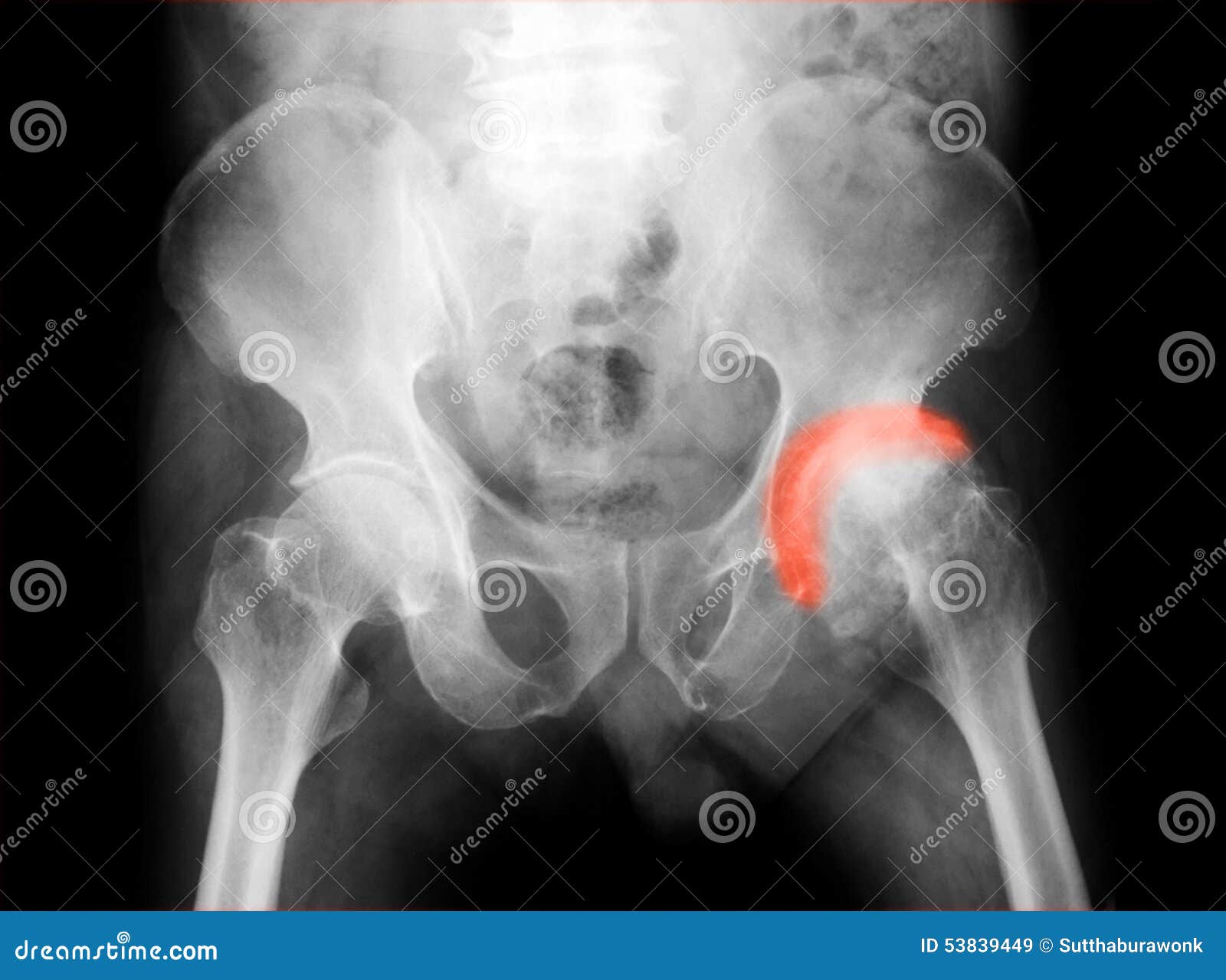 X-ray Image of Both Hip, AP View. Stock Image - Image of inflammation ...