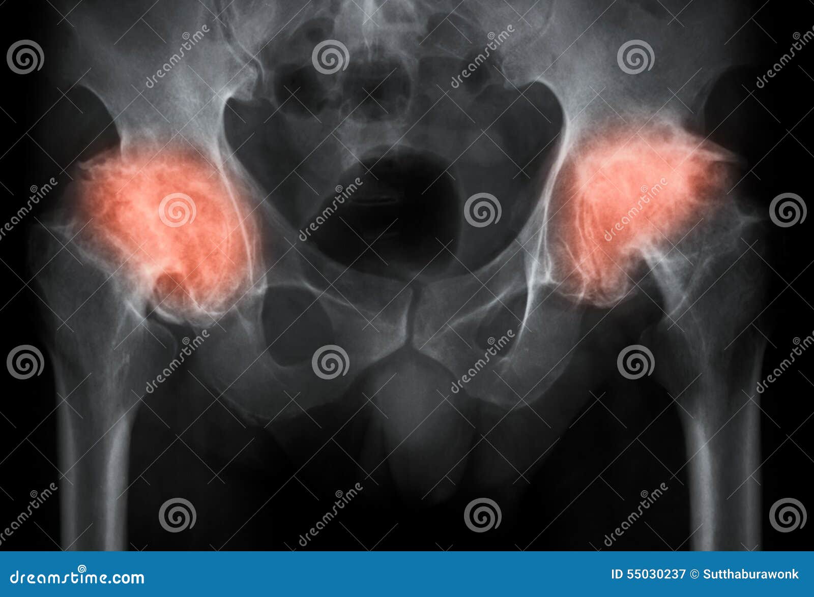 X-ray Image of Both Hip, AP View. Stock Image - Image of crest ...
