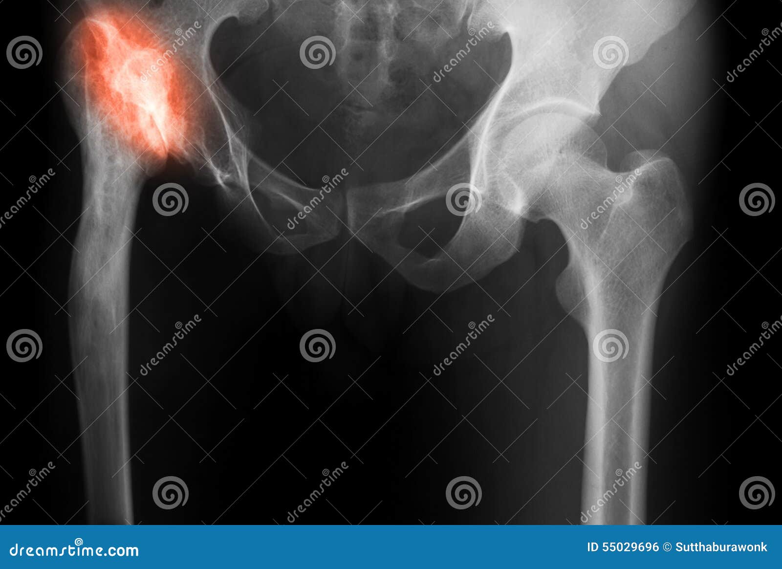 Normal xray of the hip xray - saadsuper