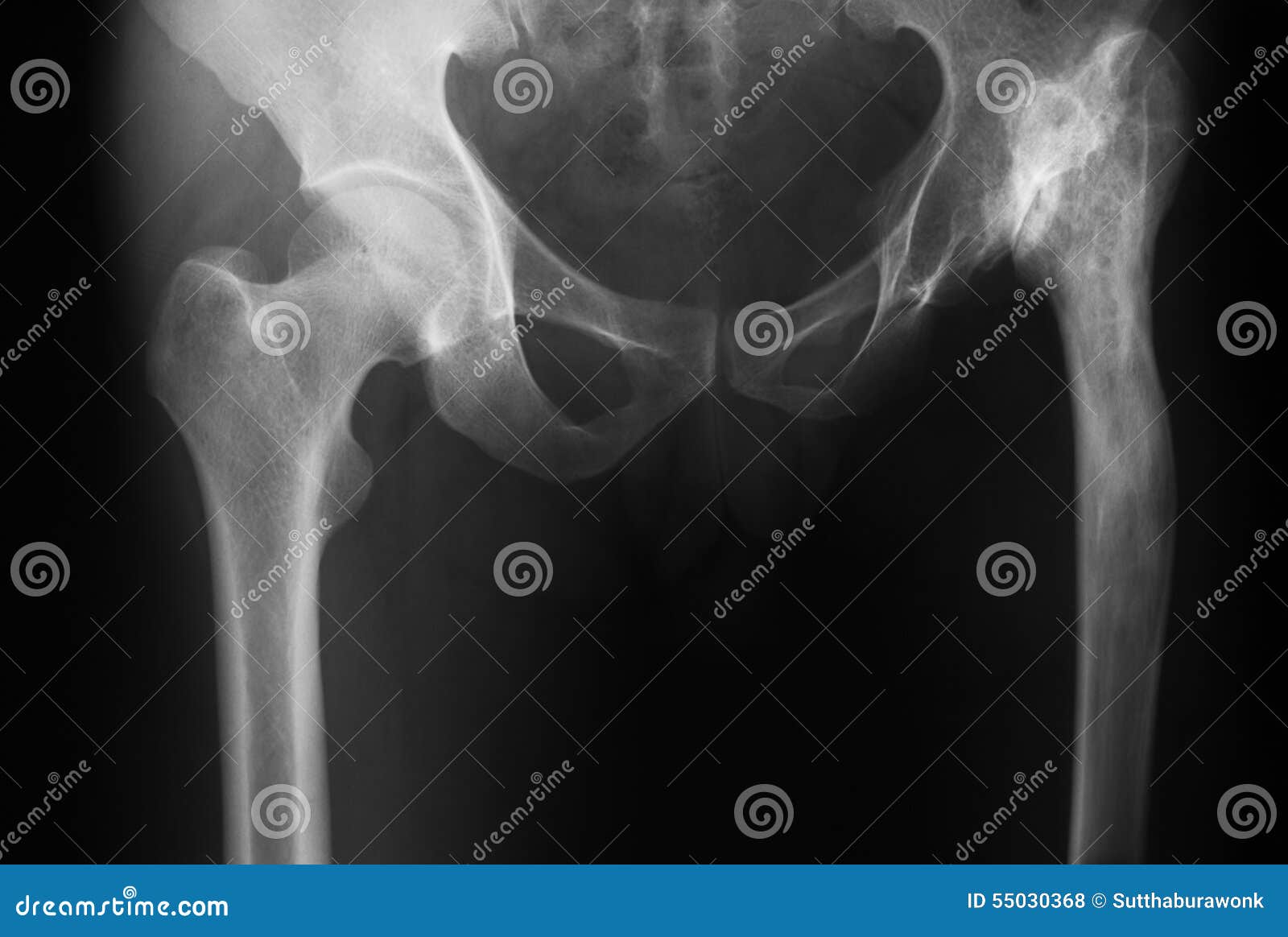X-ray Image of Both Hip, AP View. Stock Photo - Image of iliac, exam ...