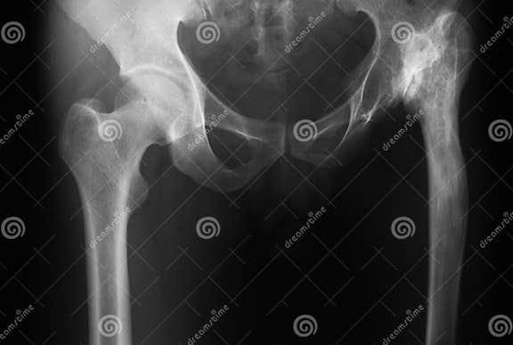 X-ray Image of Both Hip, AP View. Stock Photo - Image of iliac, exam ...