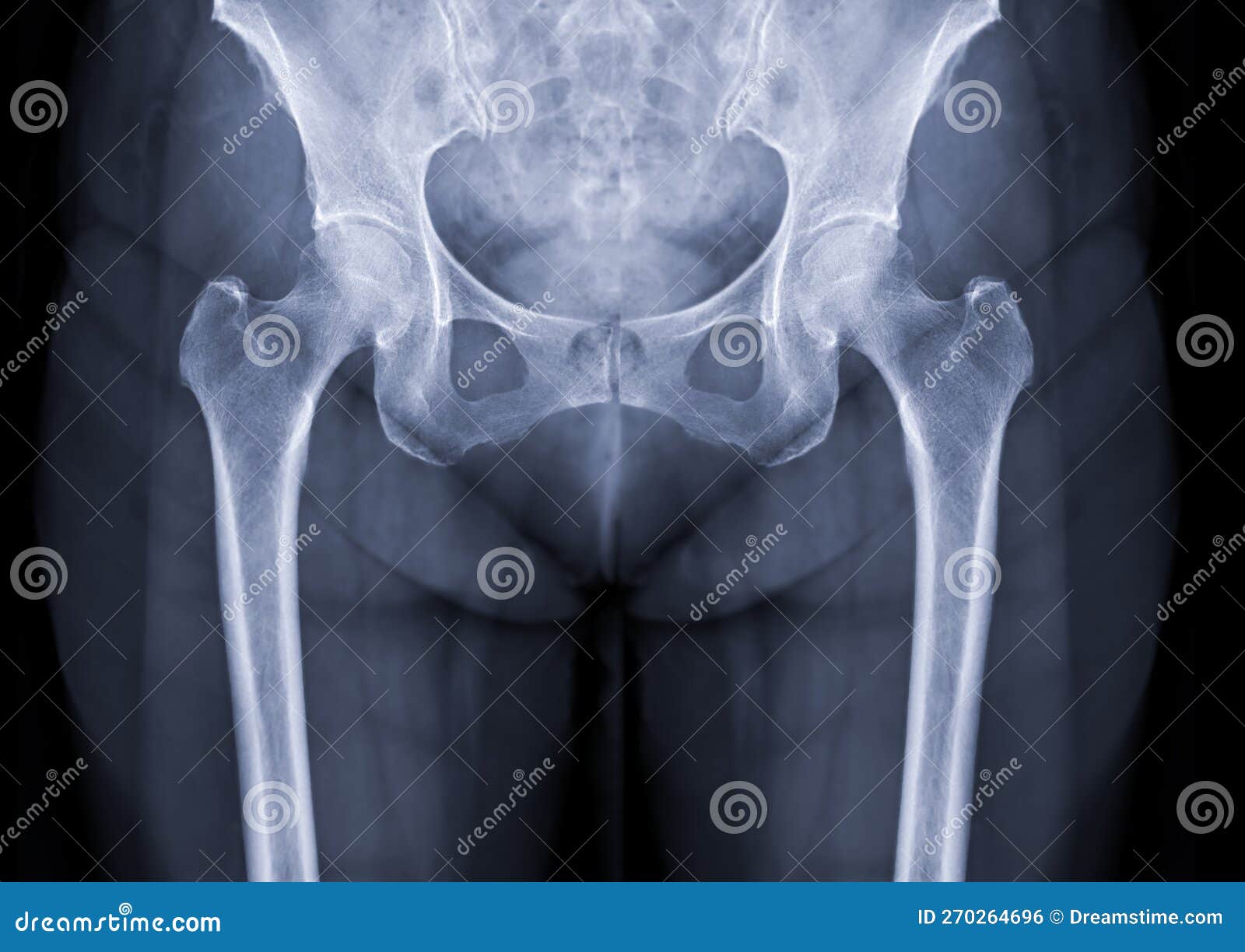 X-ray Image of Both Hip Joint Stock Photo - Image of film, black: 270264696