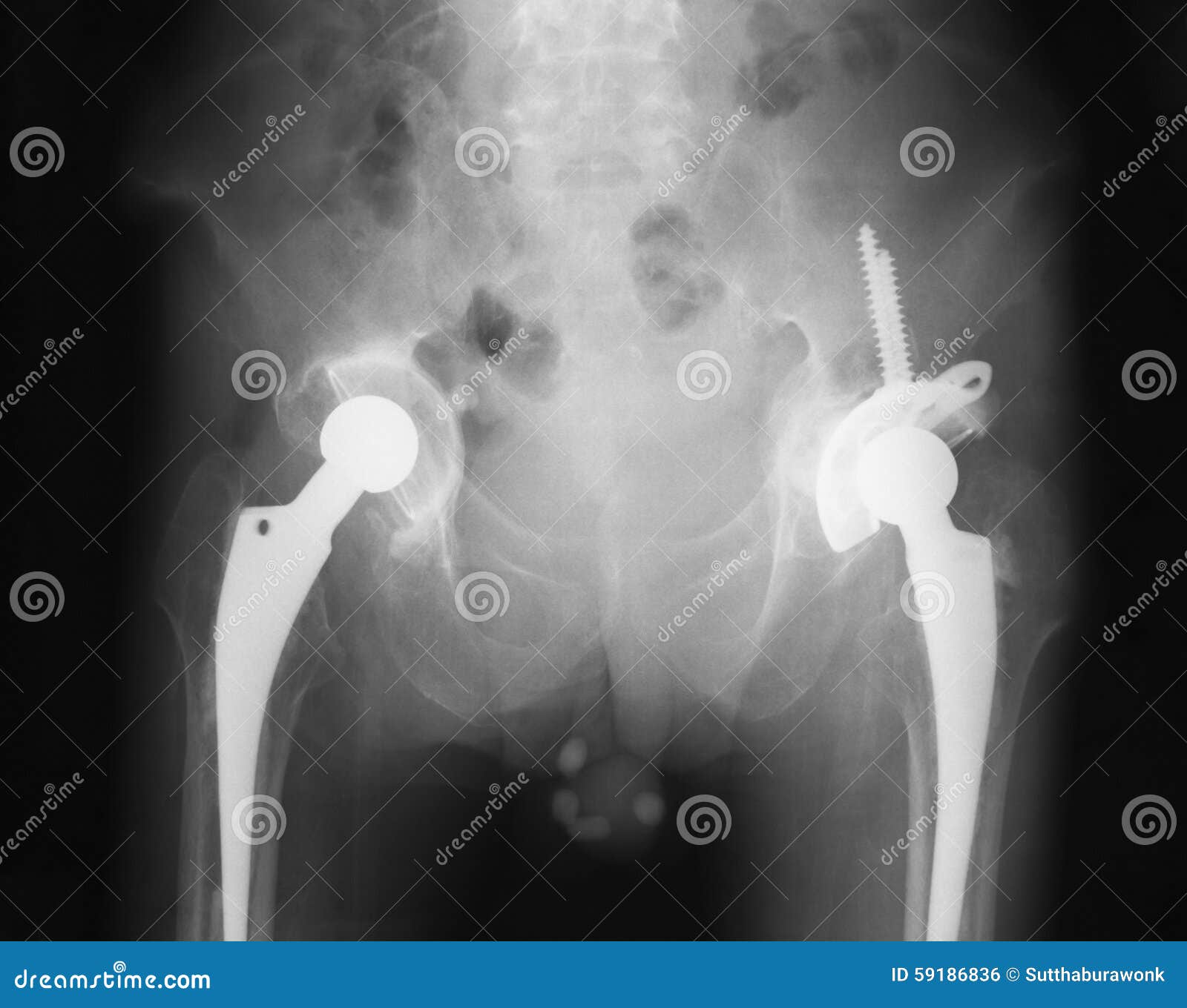 X-ray Image of Both Hip Showing Hip Replacement. Stock Photo - Image of ...