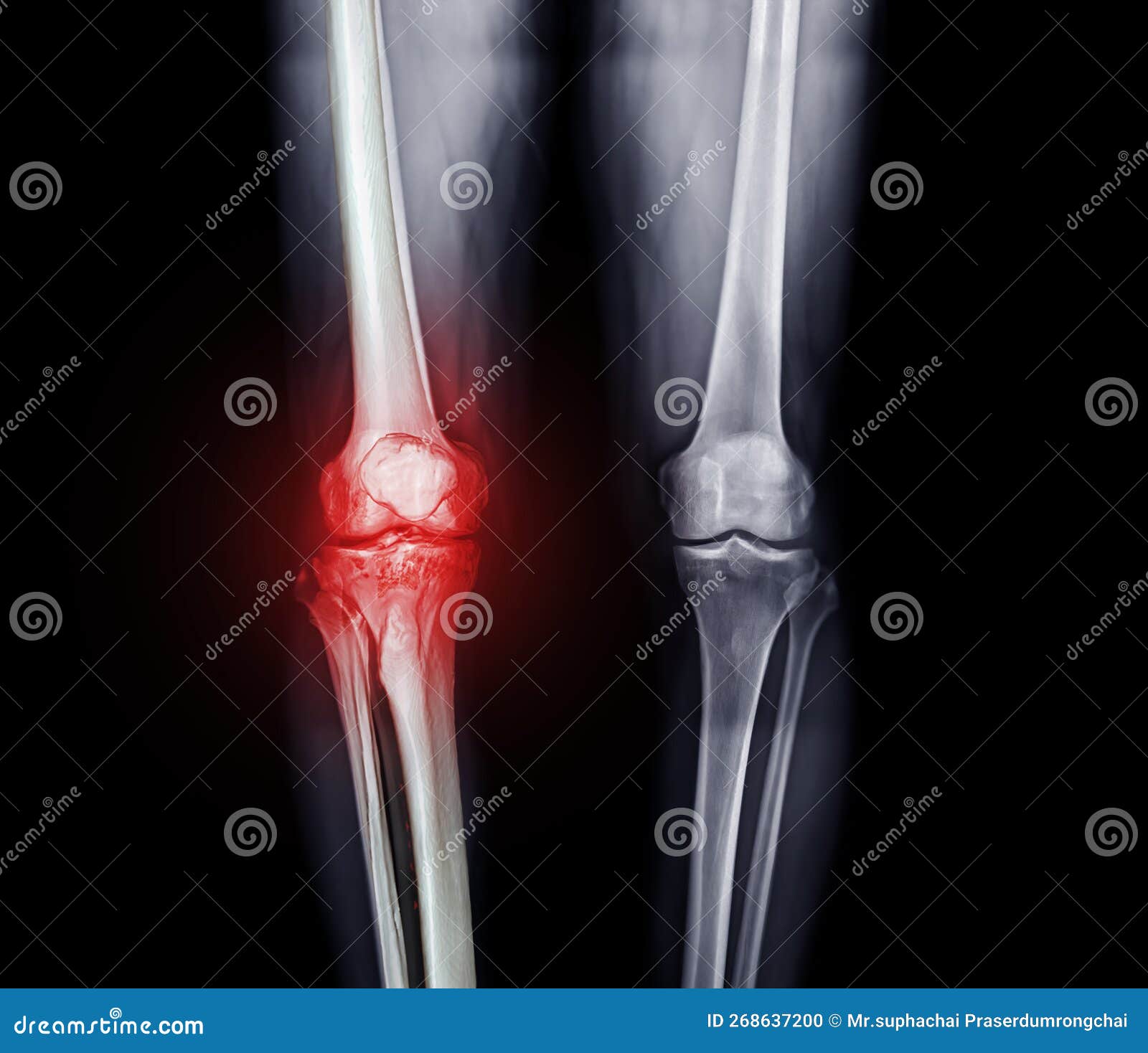X-ray Image of Both Knee AP View for Diagnostic Osteoarthritis or Knee ...