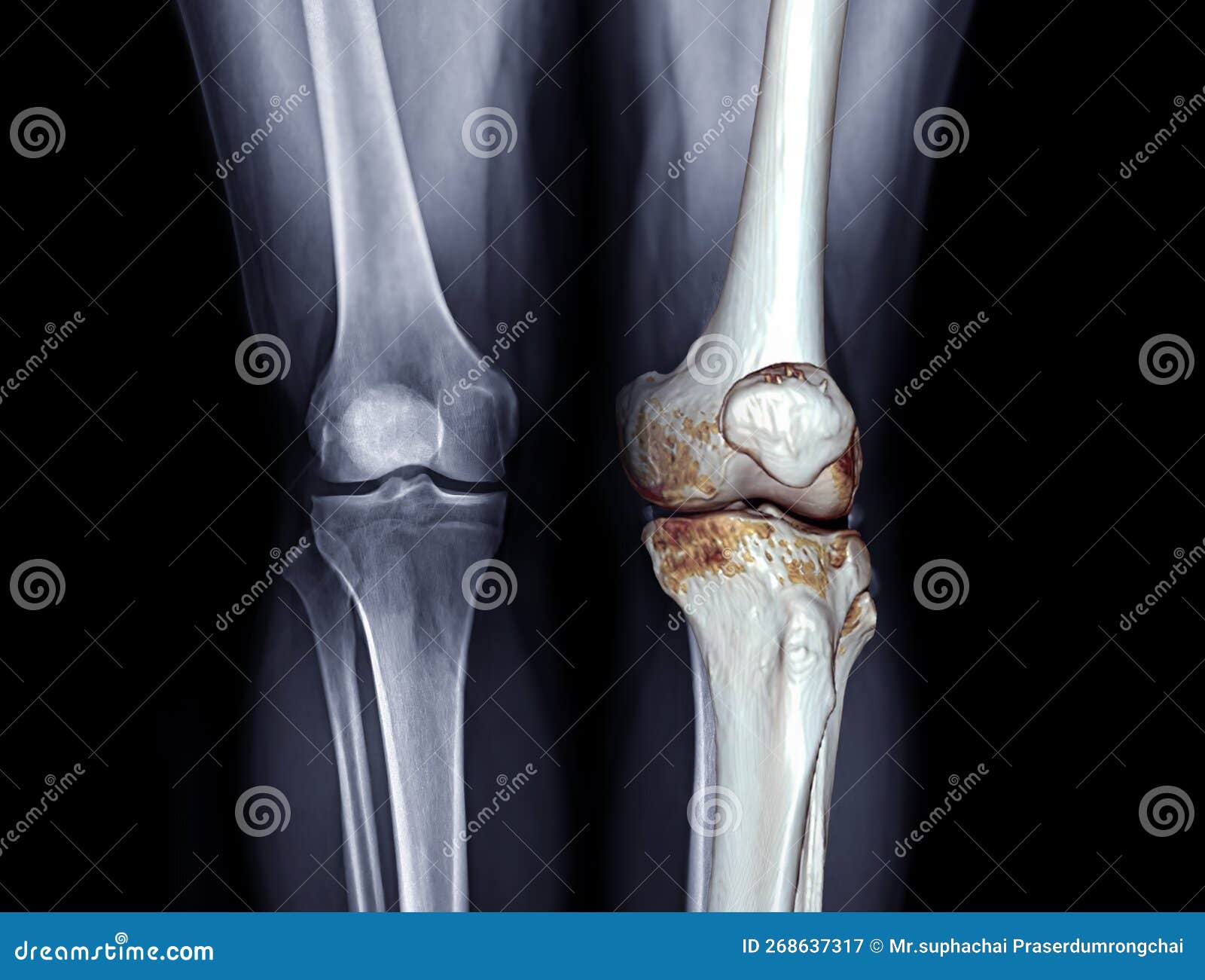 X-ray Image of Both Knee AP View for Diagnostic Osteoarthritis or Knee ...