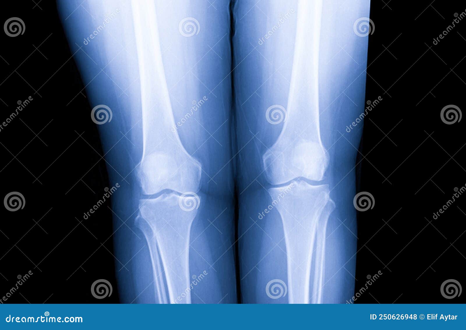 X-ray Image of Both Knee, Human`s Knee Joints Stock Photo - Image of ...