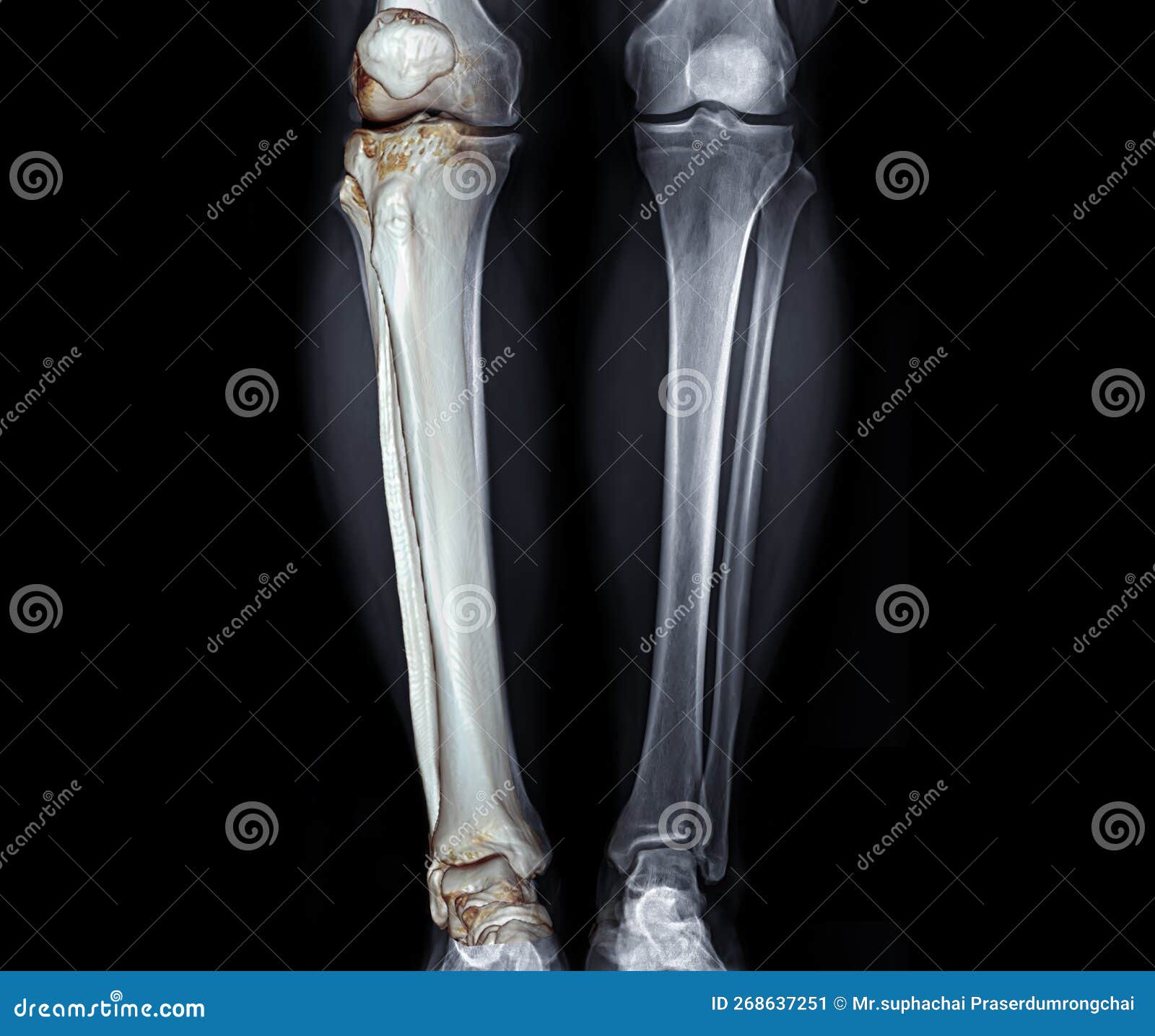 X-ray Image of Both Leg AP View with 3D Leg for Diagnostic Knee ...