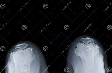 X-ray Image of Both Normal Patella Stock Photo - Image of medicine ...