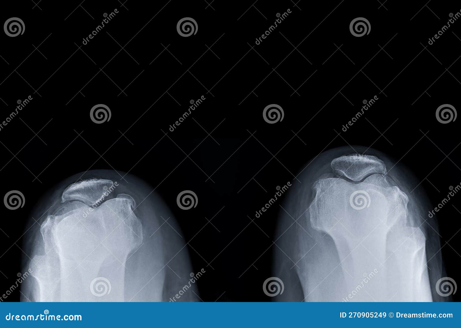 X-ray Image of Both Normal Patella Stock Image - Image of ...
