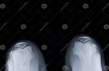 X-ray Image of Both Normal Patella Stock Image - Image of ...