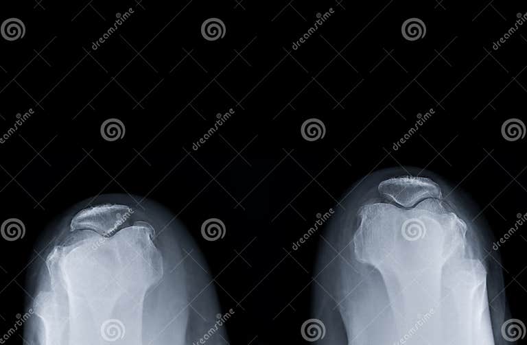 X-ray Image of Both Normal Patella Stock Image - Image of ...