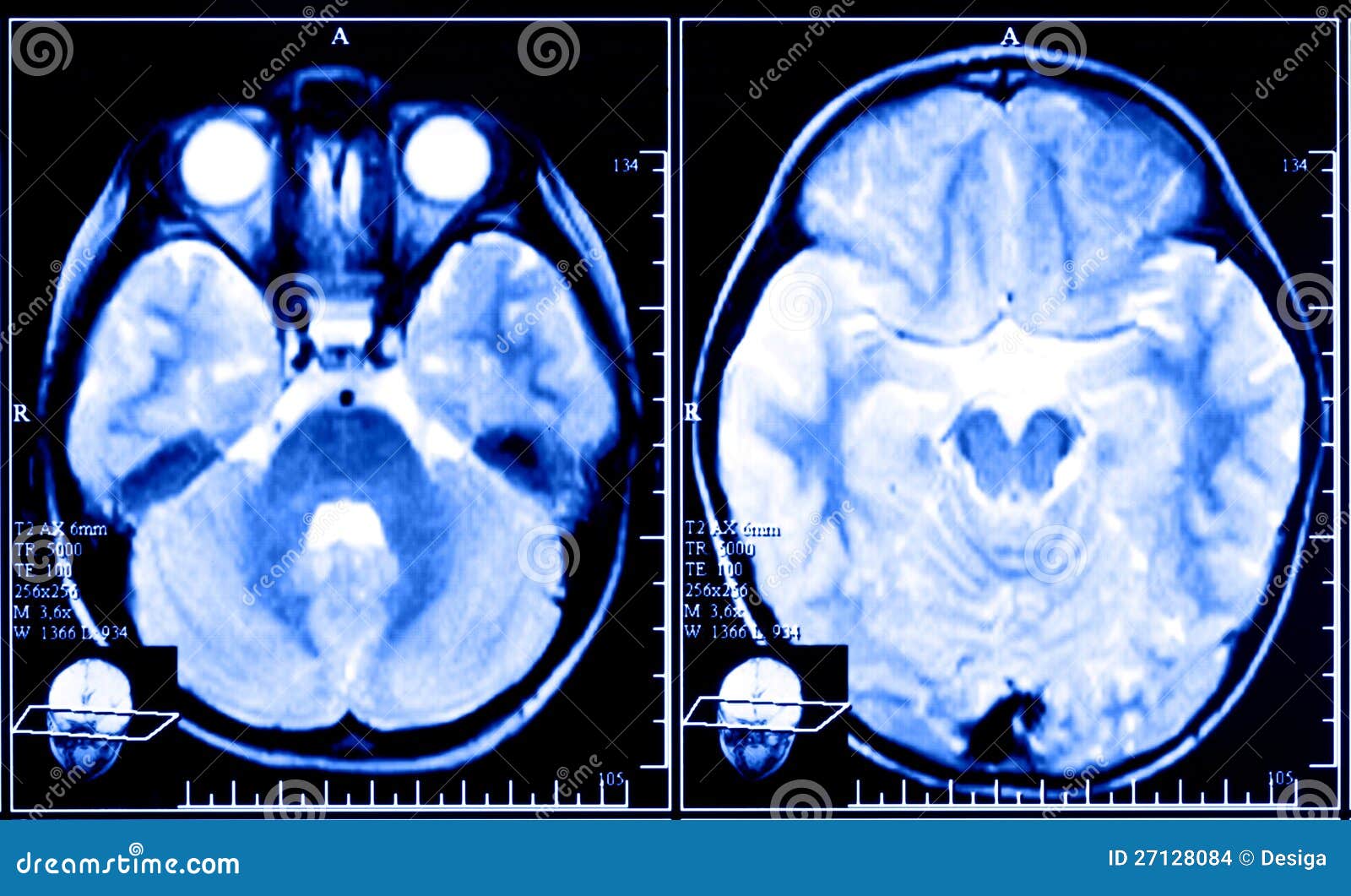 X-ray image of the brain stock photo. Image of computer - 27128084