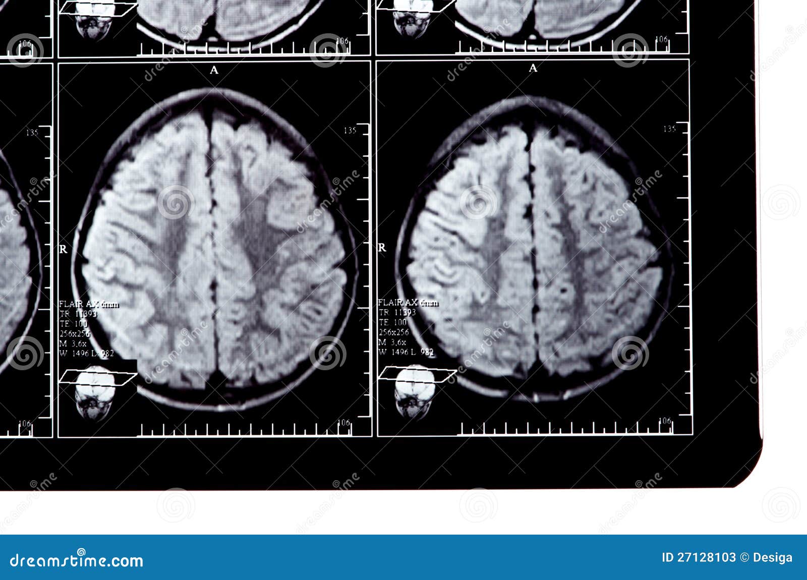 X-ray image of the brain stock image. Image of film, radiation - 27128103