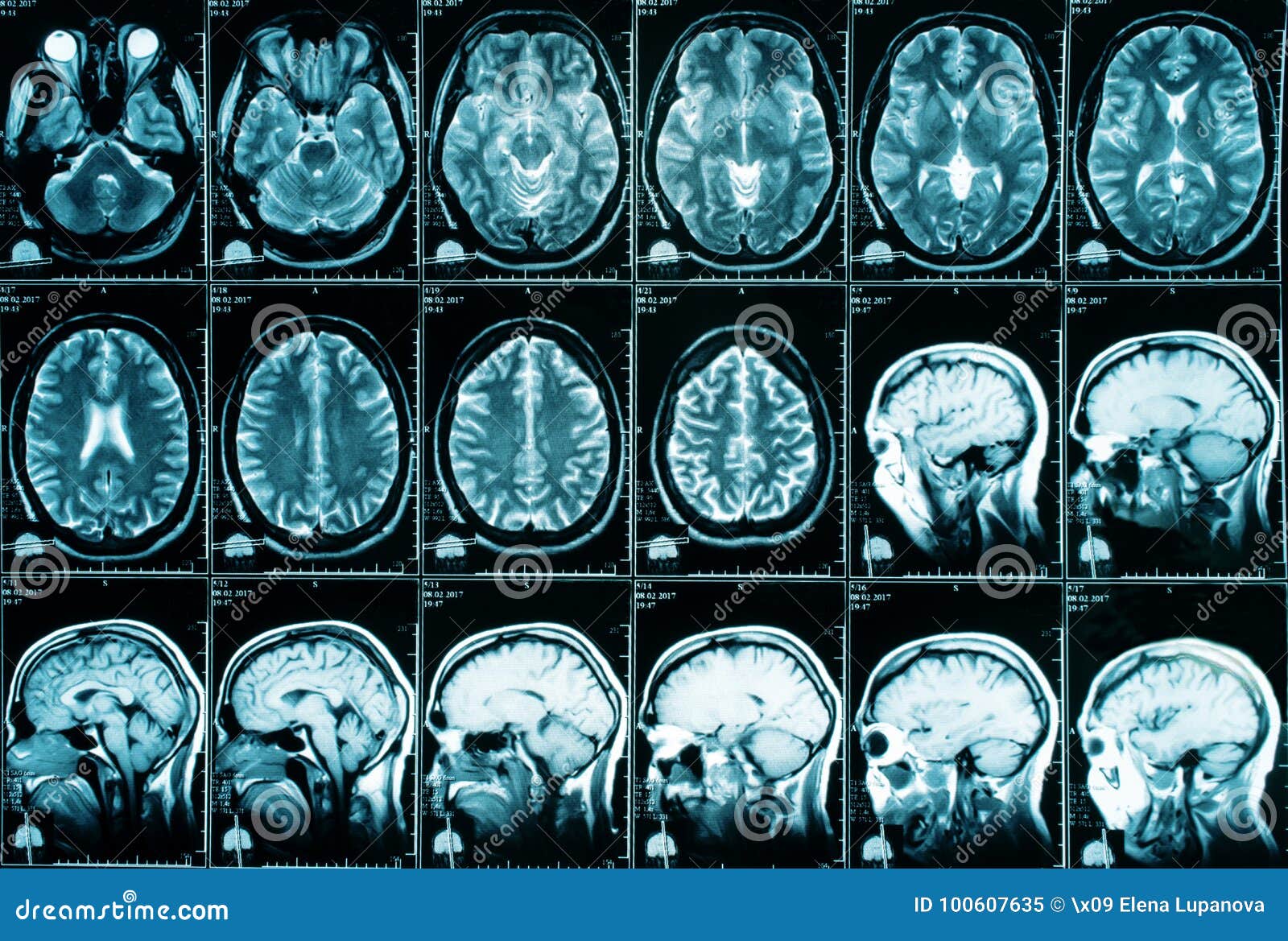 X-ray Image of the Brain Computed Tomography Stock Image - Image of ...