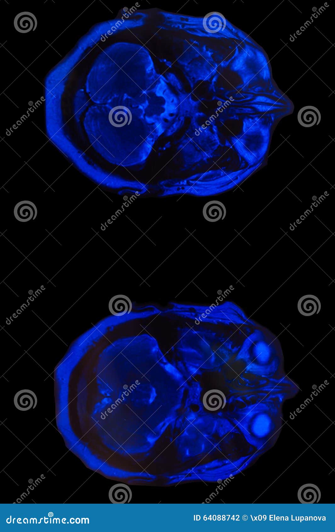 X-ray Image of the Brain Computed Tomography Stock Photo - Image of ...