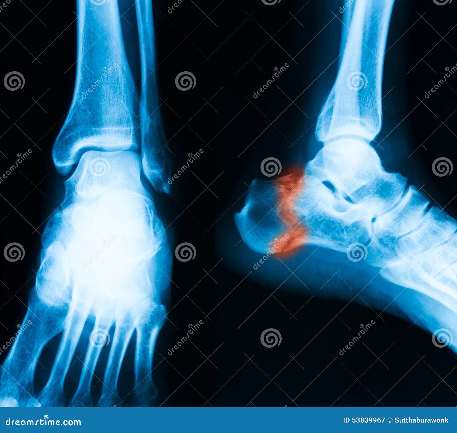 X-ray Image of Broken Calcaneus, AP and Lateral View. Stock Image ...