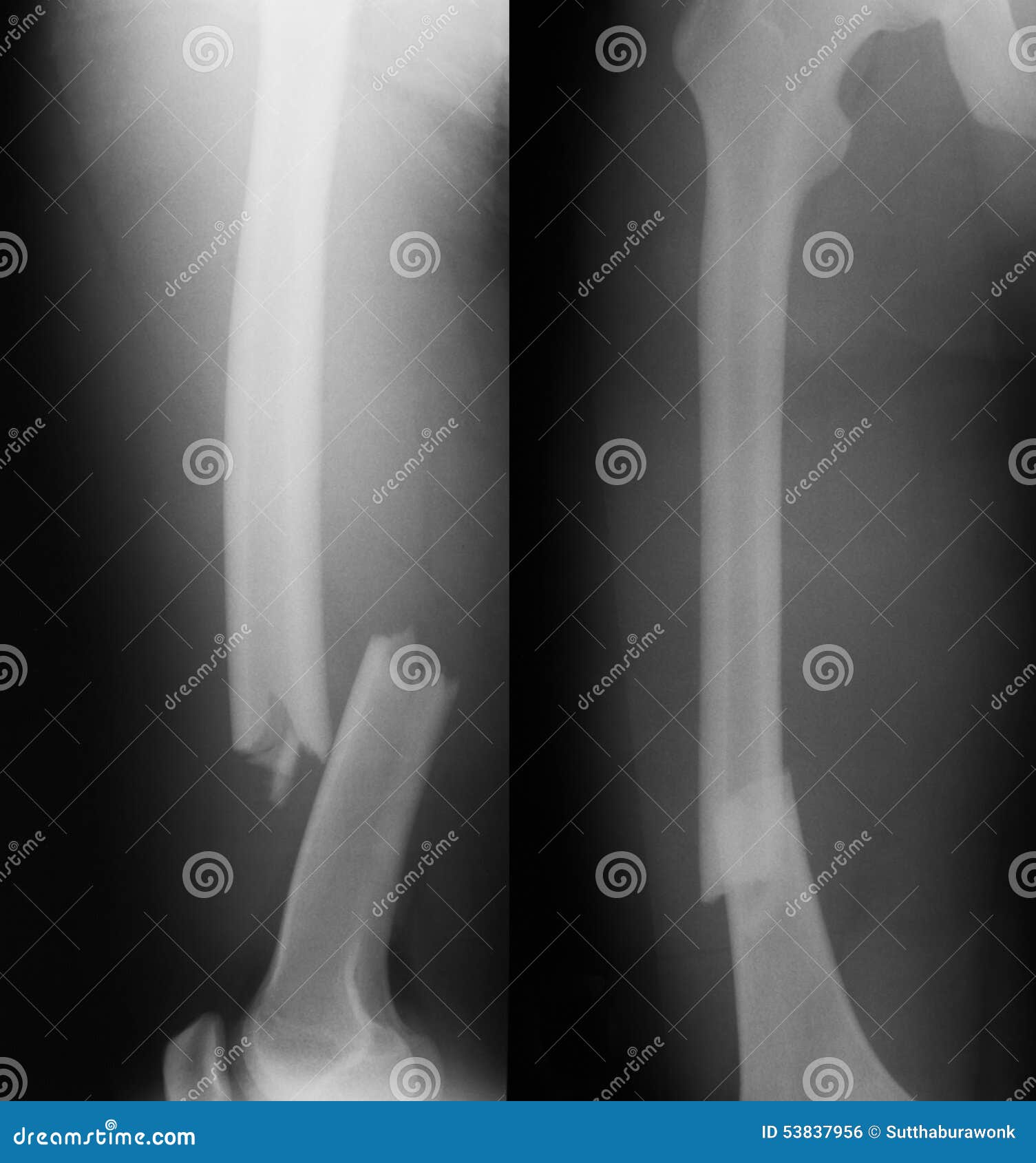 X-ray Image of Broken Femur. Stock Photo - Image of clinical, isolated ...