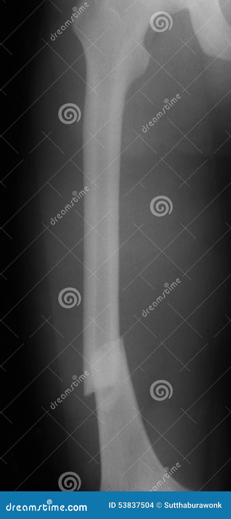 X-ray Image of Broken Femur. Stock Photo - Image of scan, extremity ...