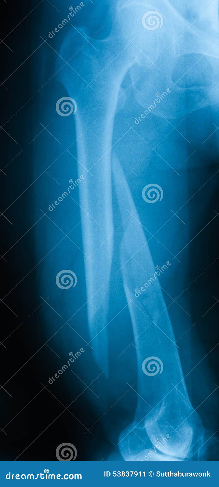 X-ray Image of Broken Femur. Stock Image - Image of medical, orthopedic ...