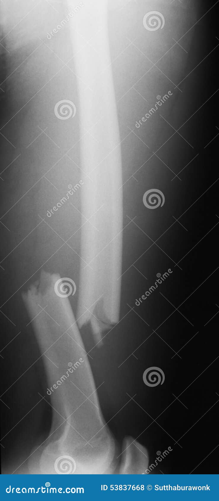 X-ray Image of Broken Femur. Stock Photo - Image of examining, doctor ...