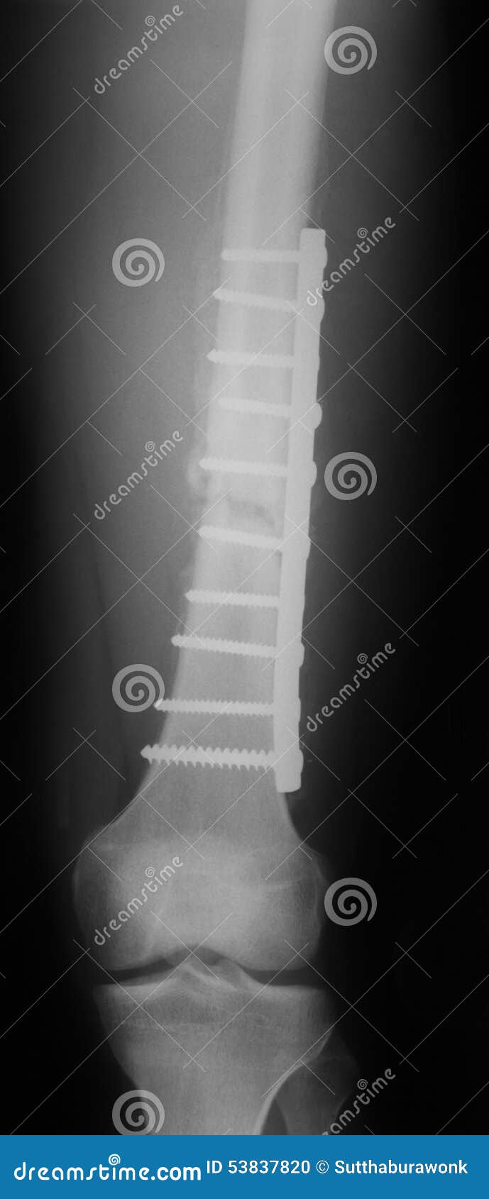 X-ray Image of Broken Femur. Stock Photo - Image of care, injury: 53837820