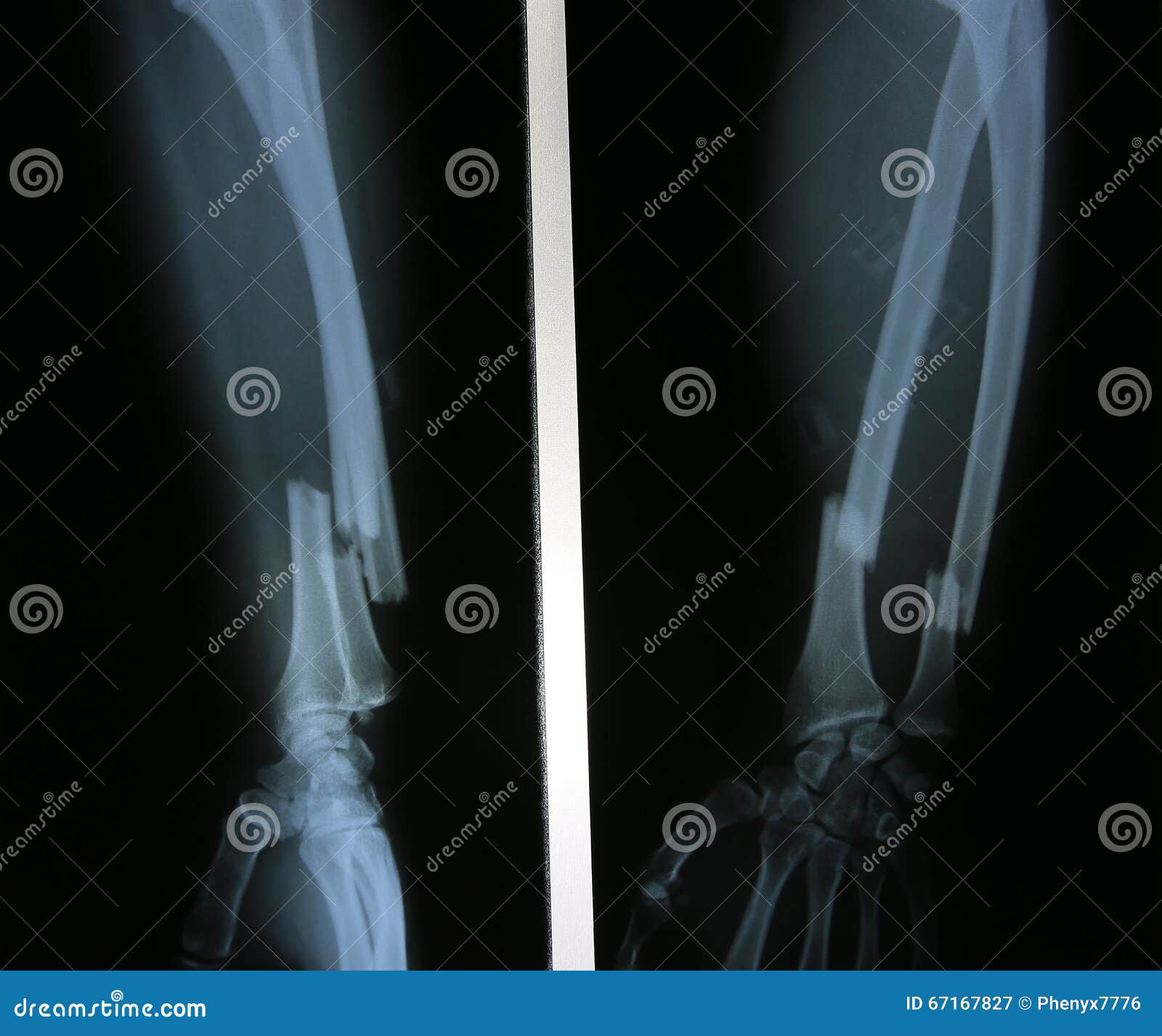 X-ray Image of Broken Forearm, AP and Lateral View Show Fracture Stock ...