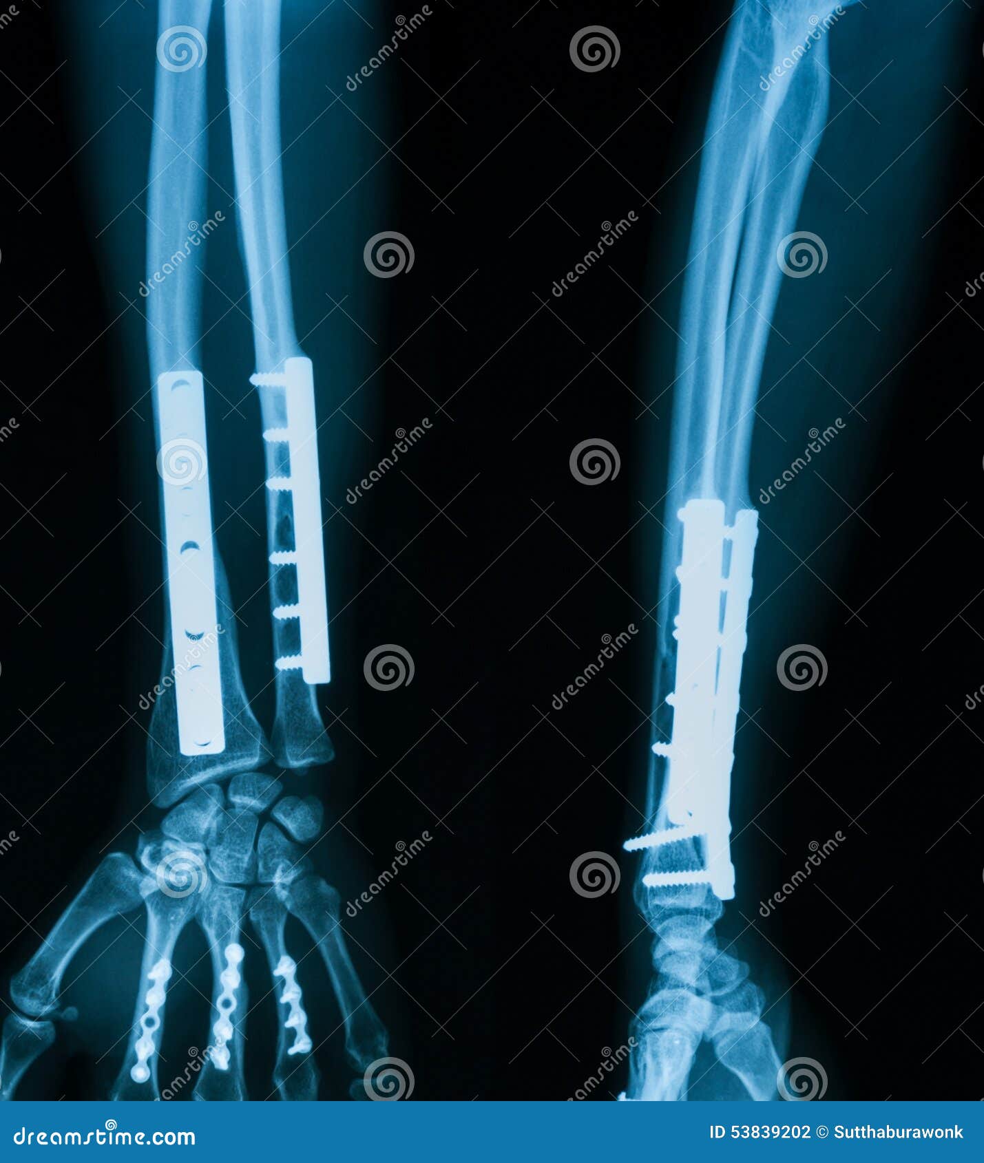X-ray Image Of Forearm, AP View (Antero-posterior View, Show Fracture ...