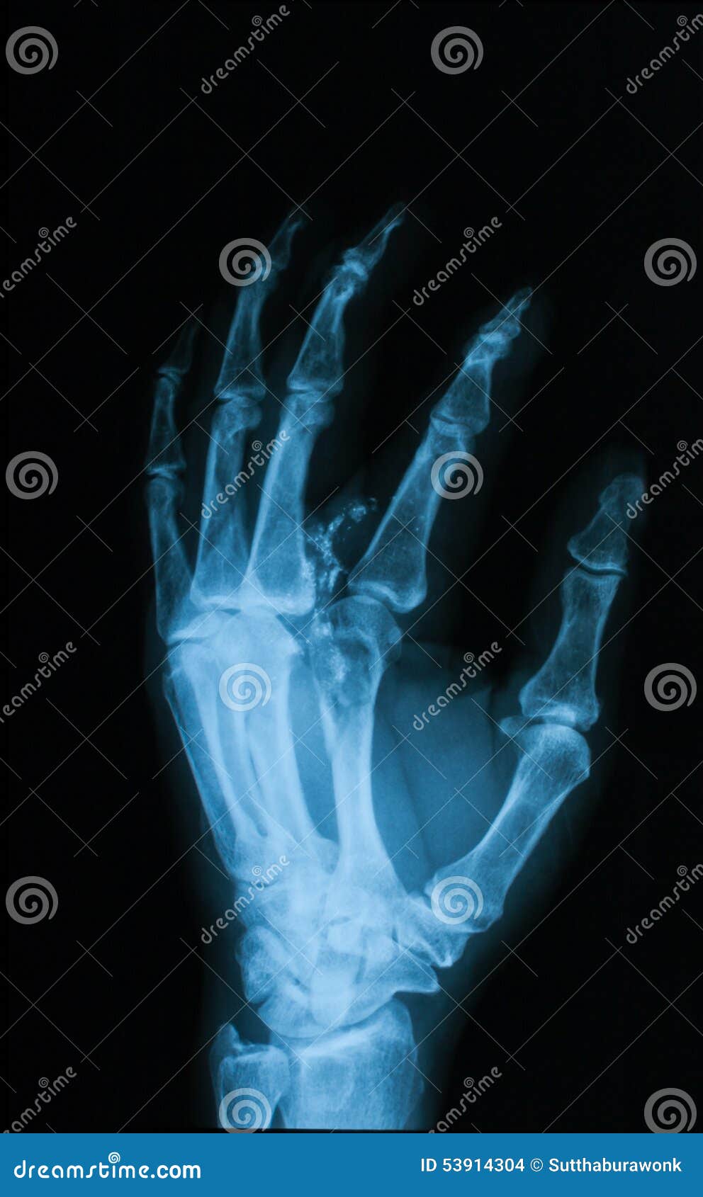 Crushed Hand X Ray