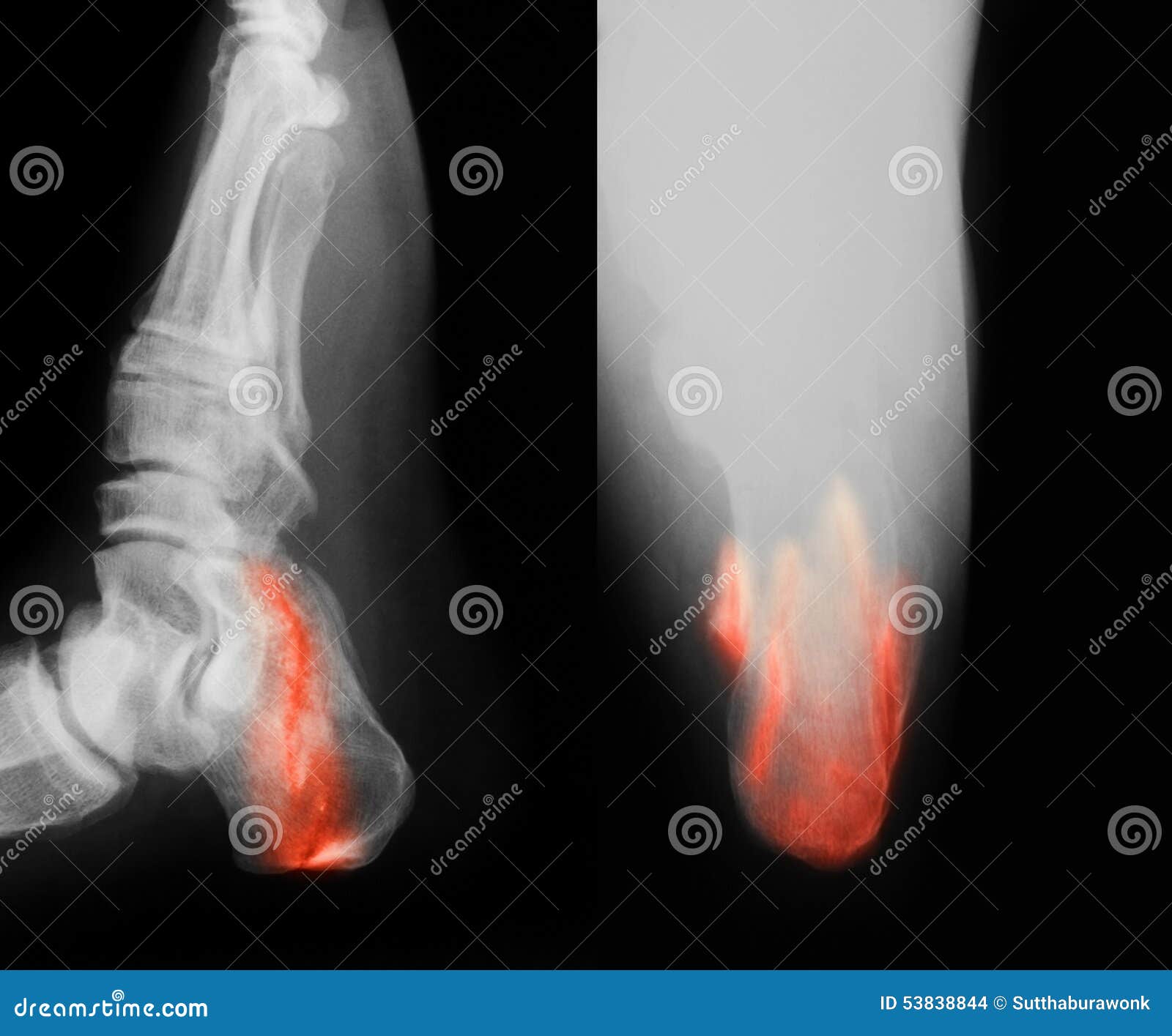 X-ray Image of Broken Heel. Stock Photo - Image of exam, foot: 53838844