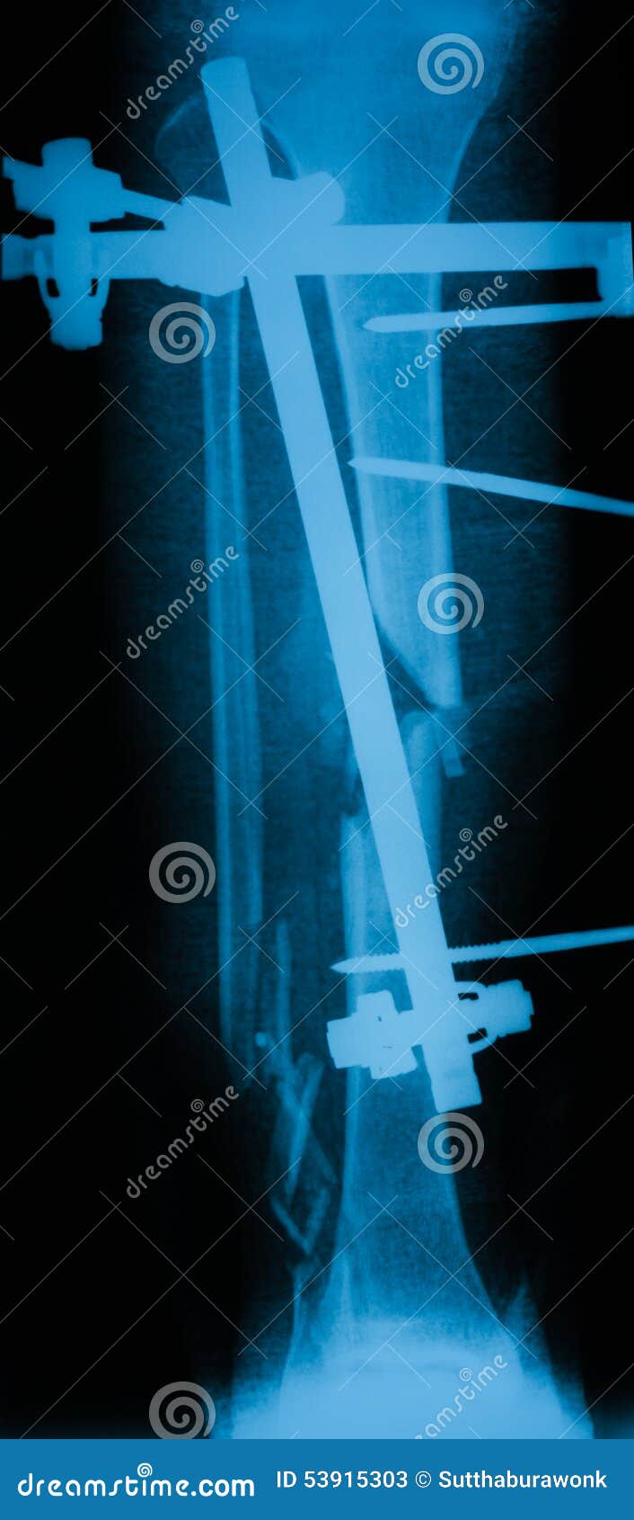 X-ray Image of Broken Leg, AP View. Stock Image - Image of fibula ...