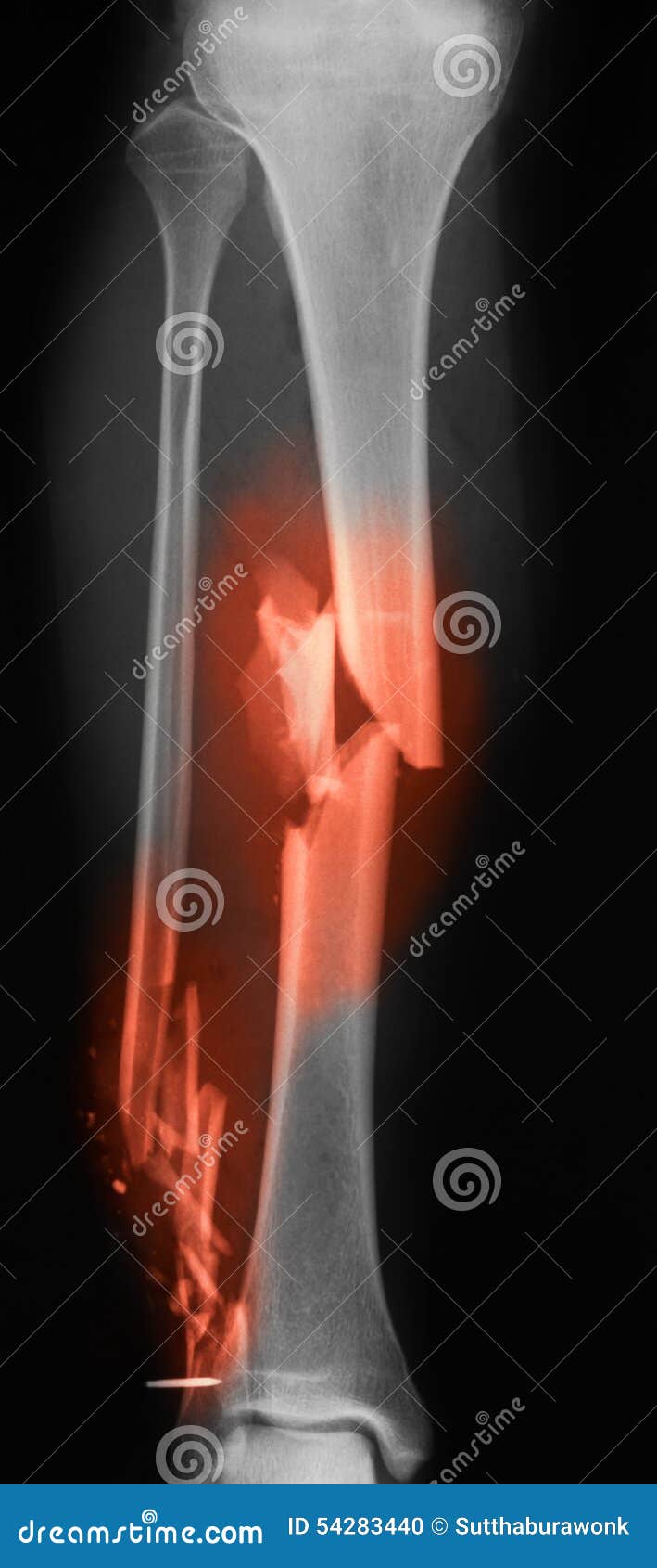 X-ray Image of Broken Leg. AP View Stock Photo - Image of lower ...
