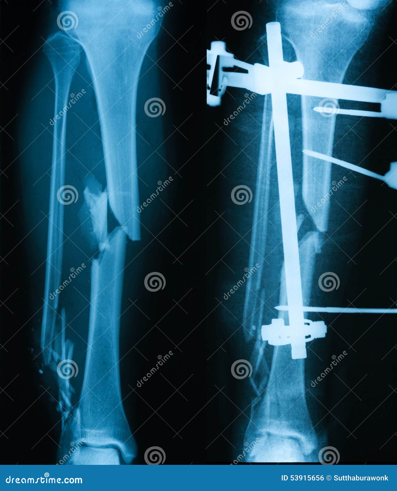 X-ray Image of Broken Leg, AP View. Stock Photo - Image of patient ...