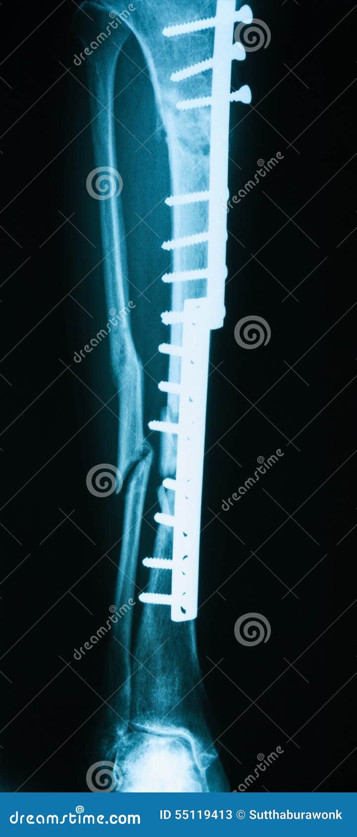 X-ray Image of Broken Leg, AP View. Stock Image - Image of orthopedic ...