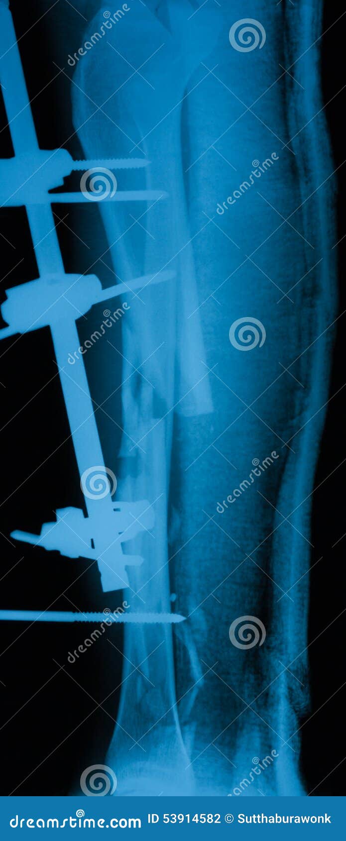 Broken Leg (broken Tibia) Radiography Stock Photography | CartoonDealer ...