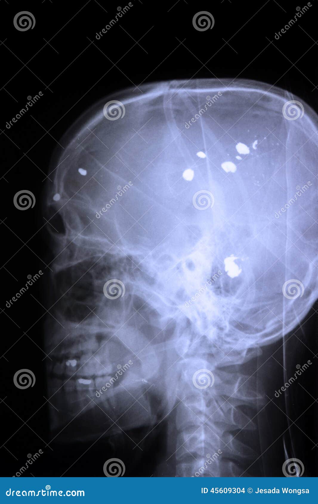 X Ray Image of a Bullet from Gun in Head. Stock Photo - Image of ...