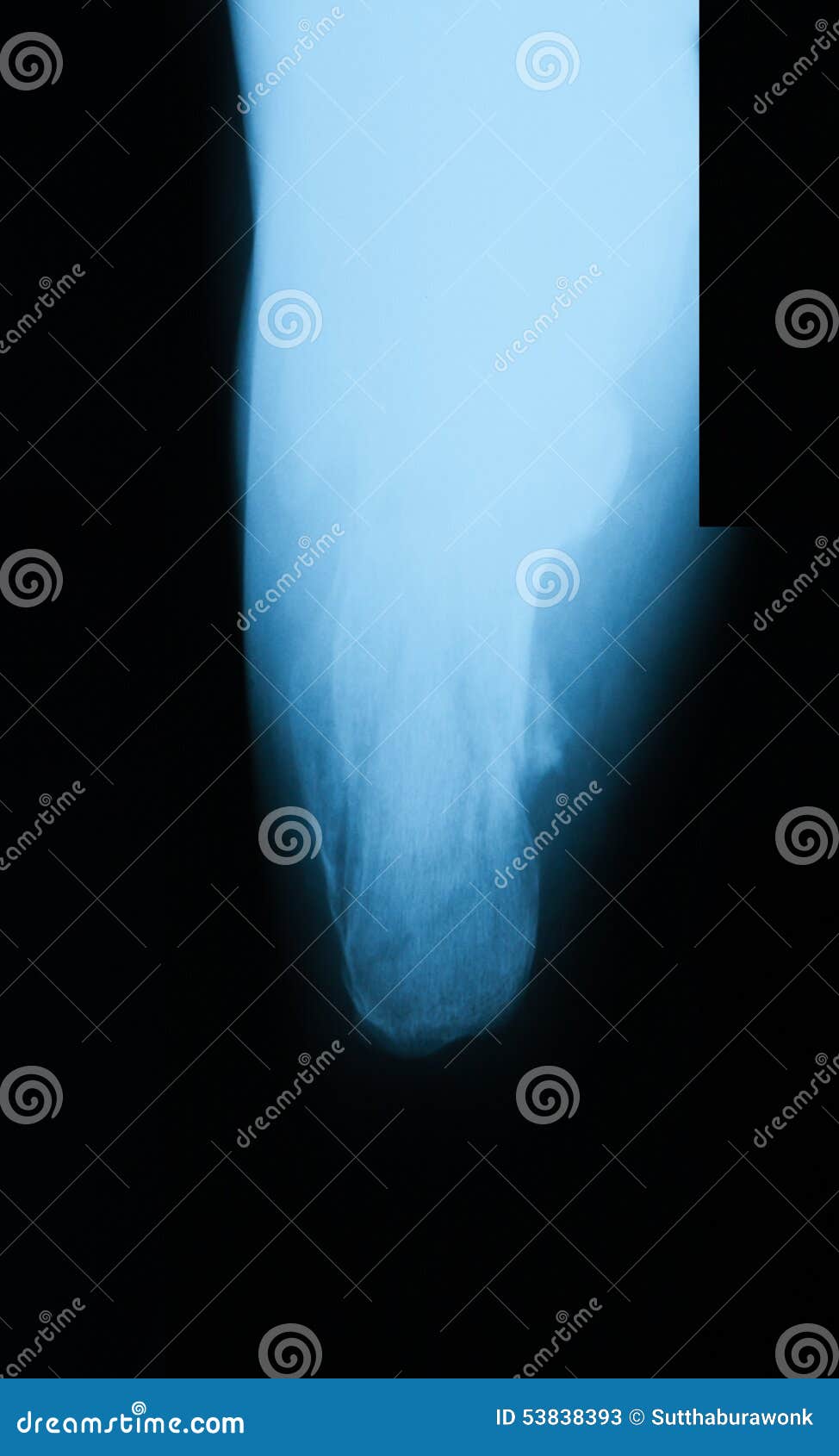X-ray image of calcaneus. stock image. Image of foot - 53838393