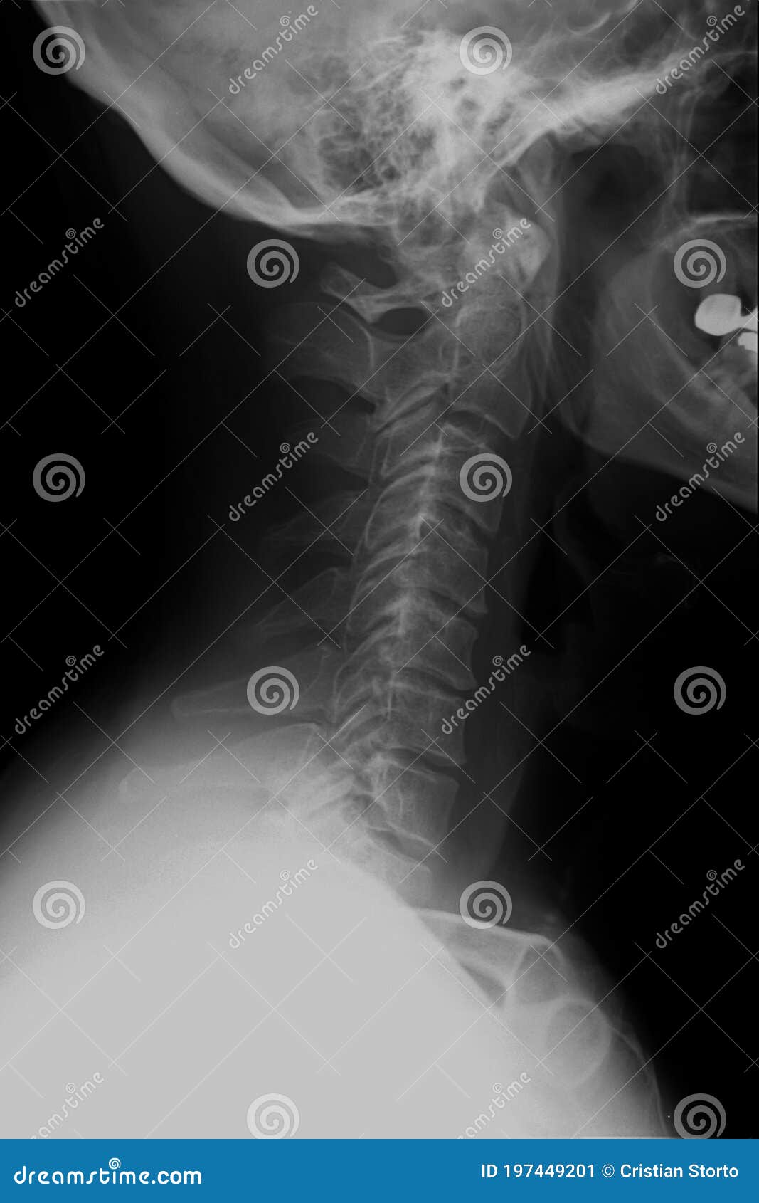 X-ray Image of Cervical, Lateral View Stock Image - Image of abstract ...