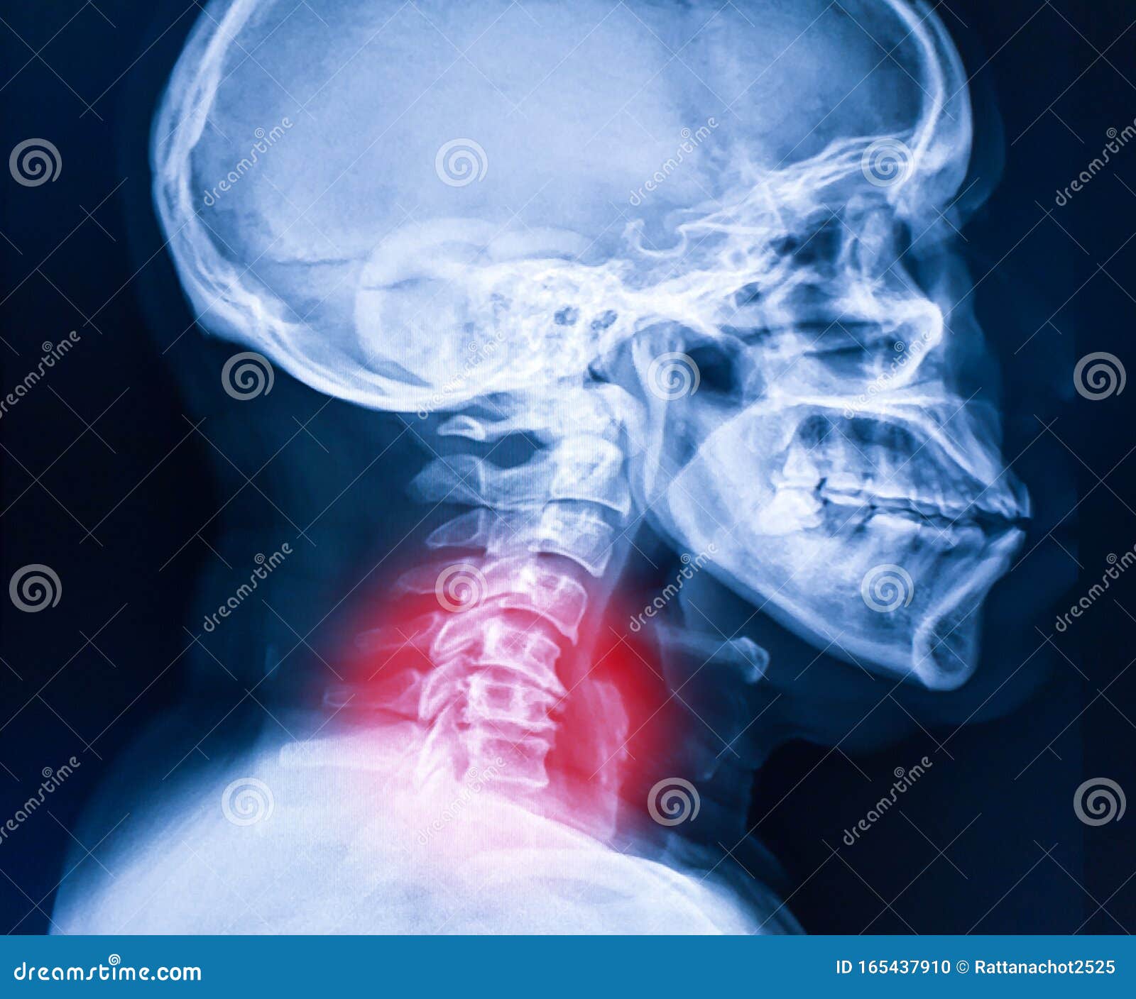 X-ray Image And MRI Of Cervical Spine Case Trauma Showing C4,5 ...